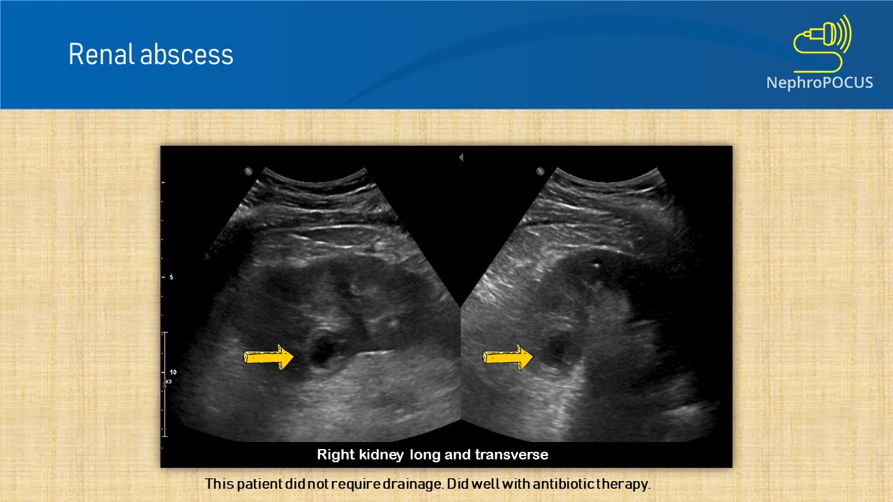 Renal abscess – NephroPOCUS