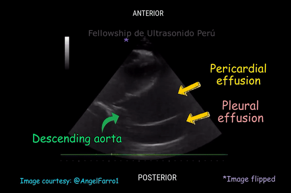 Pericardial versus pleural effusion on PLAX view – NephroPOCUS