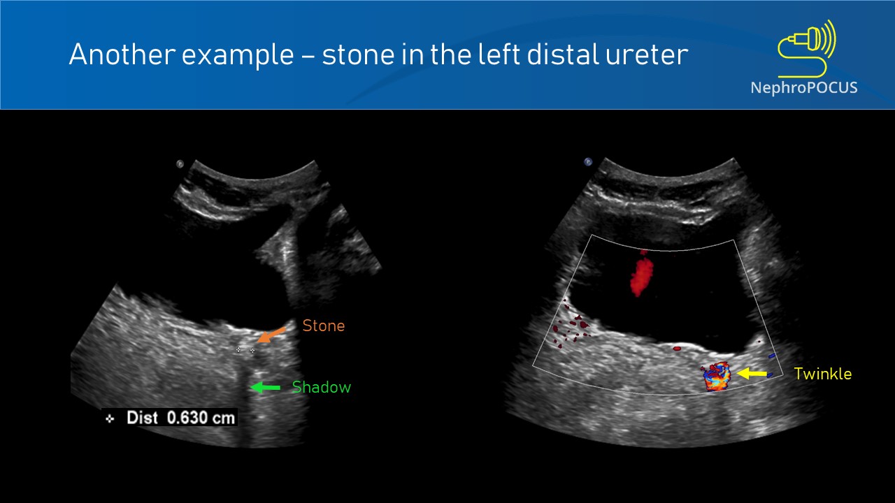 Ureterovesical junction stone – NephroPOCUS