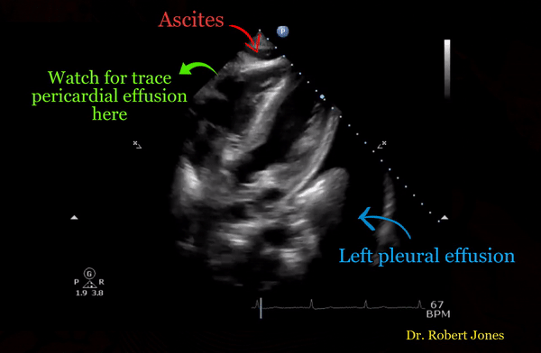 Pericardial Effusion Echo