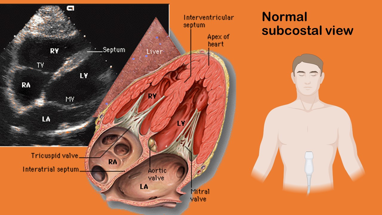Septal bounce in a lupus patient – NephroPOCUS