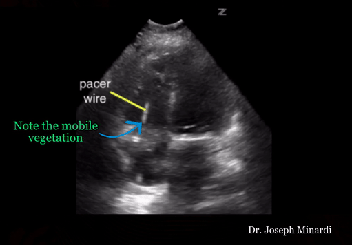 Valvular vegetations – NephroPOCUS