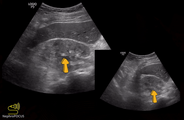 Sonographic appearance of an ureteral stent – NephroPOCUS