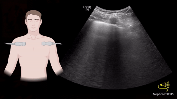 An intriguing tale of B-lines in a dialysis patient – NephroPOCUS