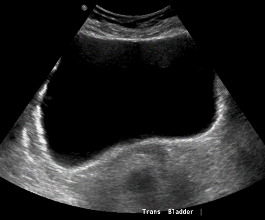 Bladder normal – NephroPOCUS