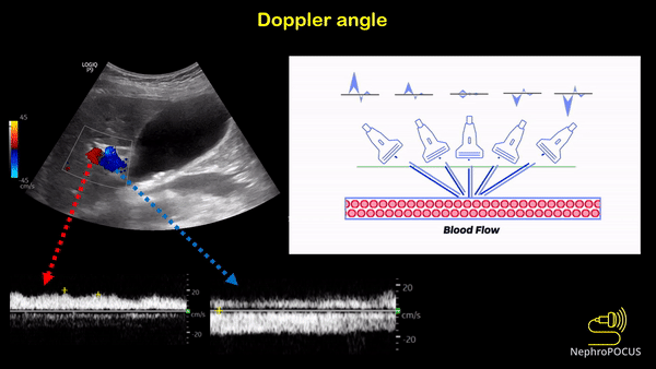 Infographics – NephroPOCUS