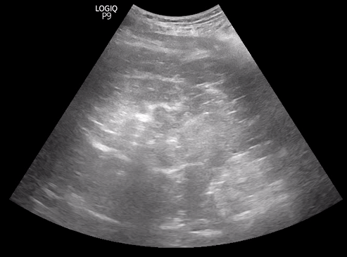 Accessory Spleen – NephroPOCUS