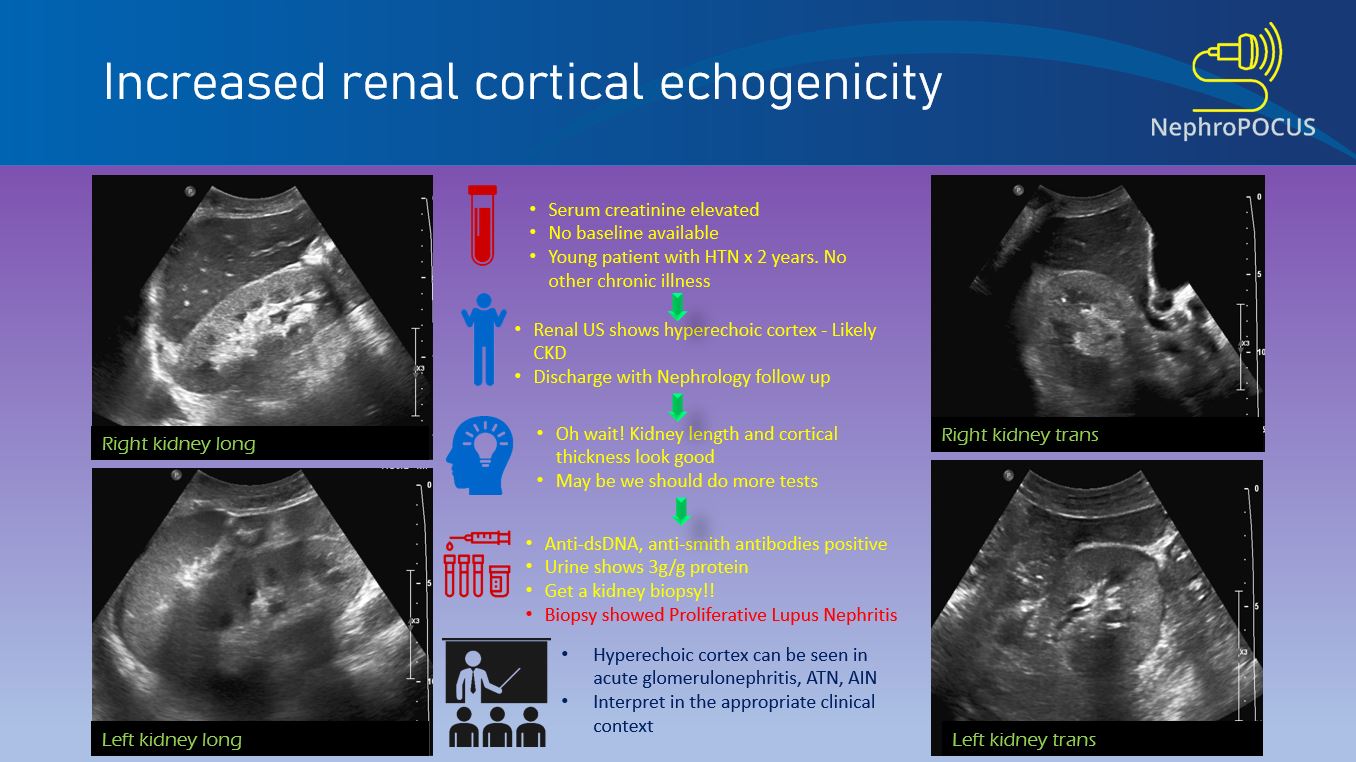 Increased renal cortical echogenicity does not always indicate chronic ...