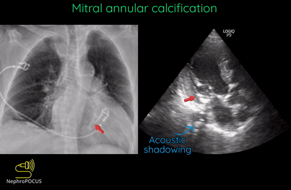 Mitral annular calcification – NephroPOCUS