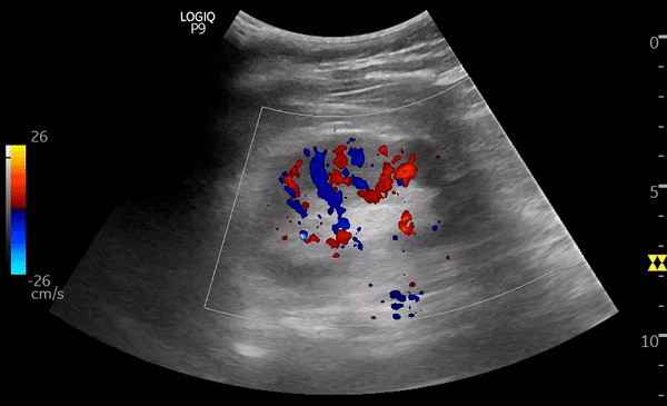Renal infarction – NephroPOCUS