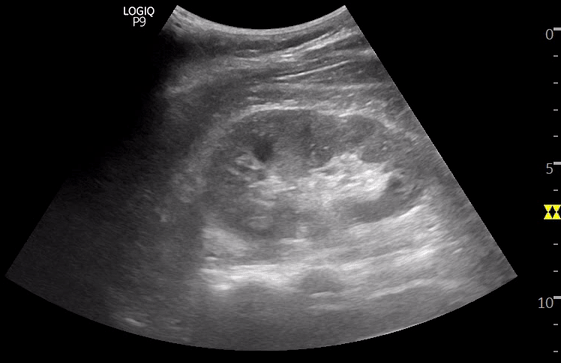 Renal infarction – NephroPOCUS