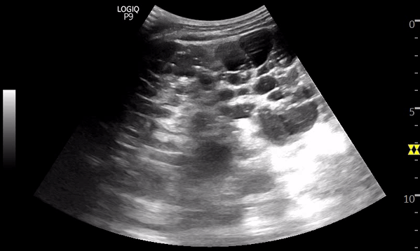 Multiple cysts in the kidneys – NephroPOCUS