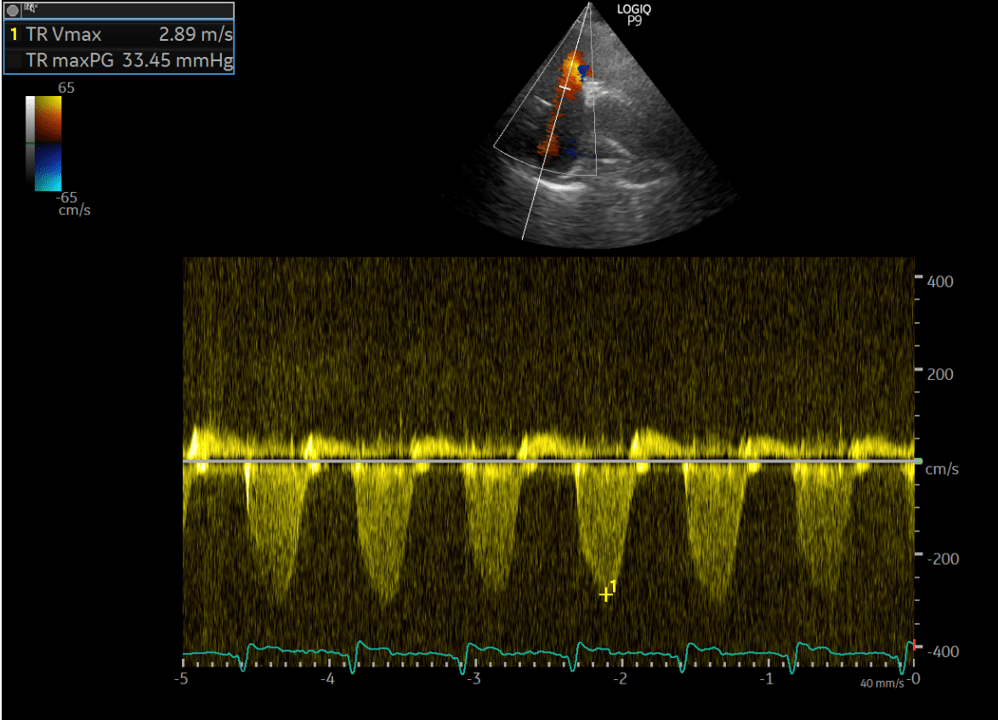 The RV inflow view – NephroPOCUS