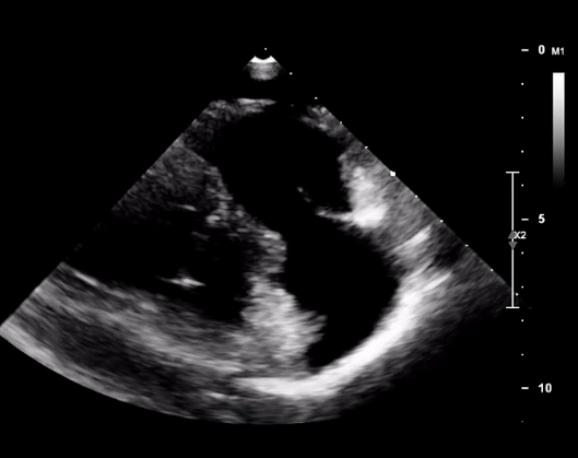 The RV inflow view – NephroPOCUS