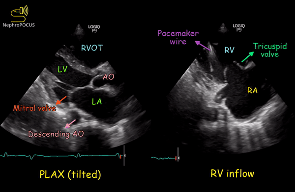 The RV inflow view – NephroPOCUS
