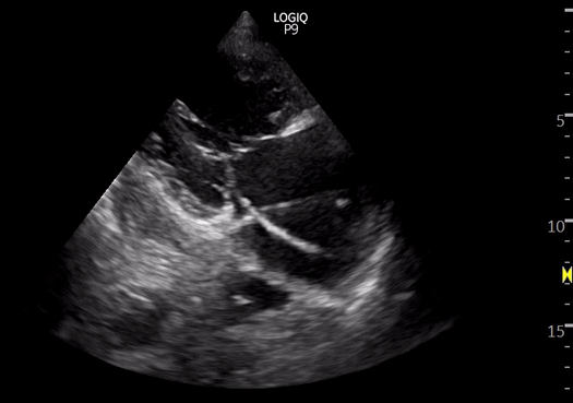The RV inflow view – NephroPOCUS