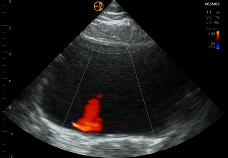 Ureteral jets – NephroPOCUS