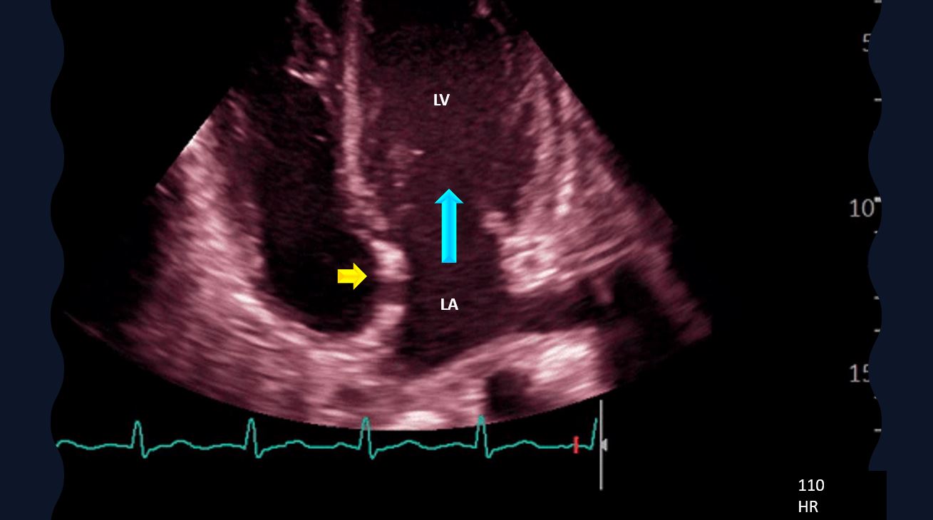 Movement of the inter-atrial septum: everything has meaning – NephroPOCUS