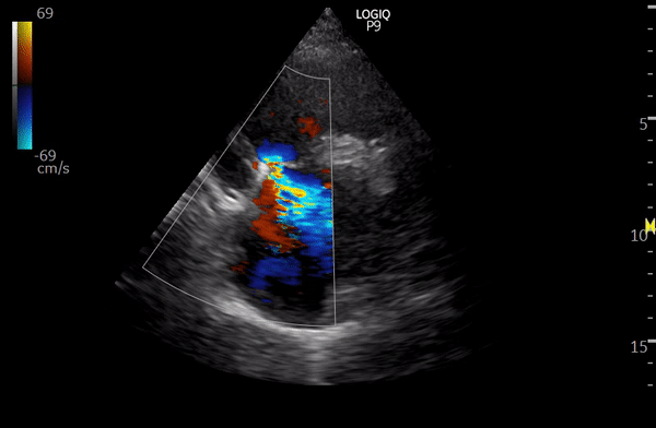 The RV inflow view – NephroPOCUS