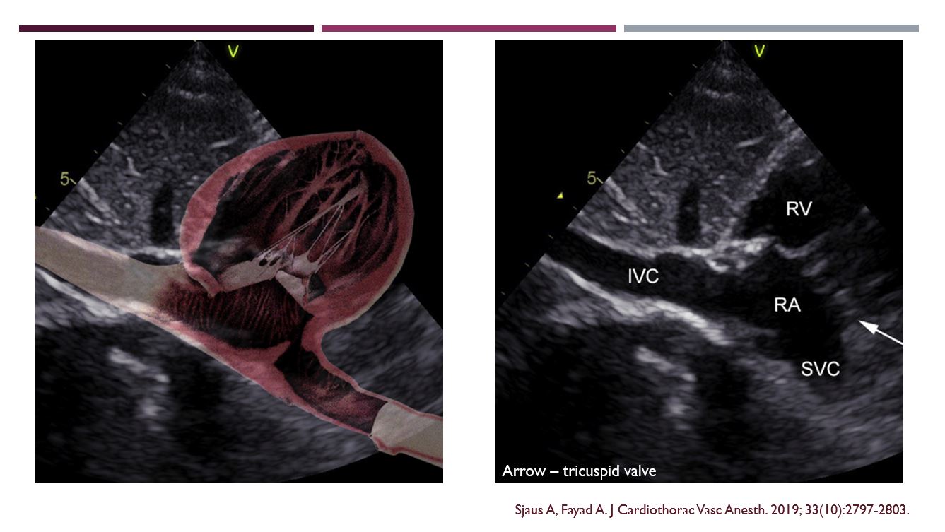 The subcostal bicaval view – NephroPOCUS