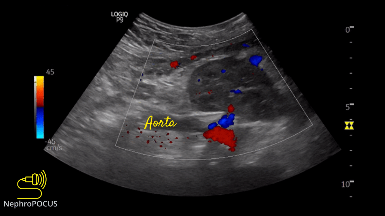 Pelvic Kidney – NephroPOCUS