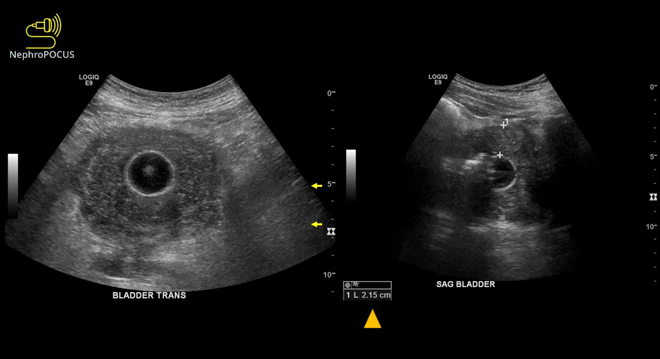 Urinary bladder wall thickness: what is the number to remember ...