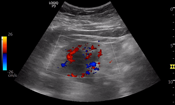 Parapelvic Cyst – NephroPOCUS