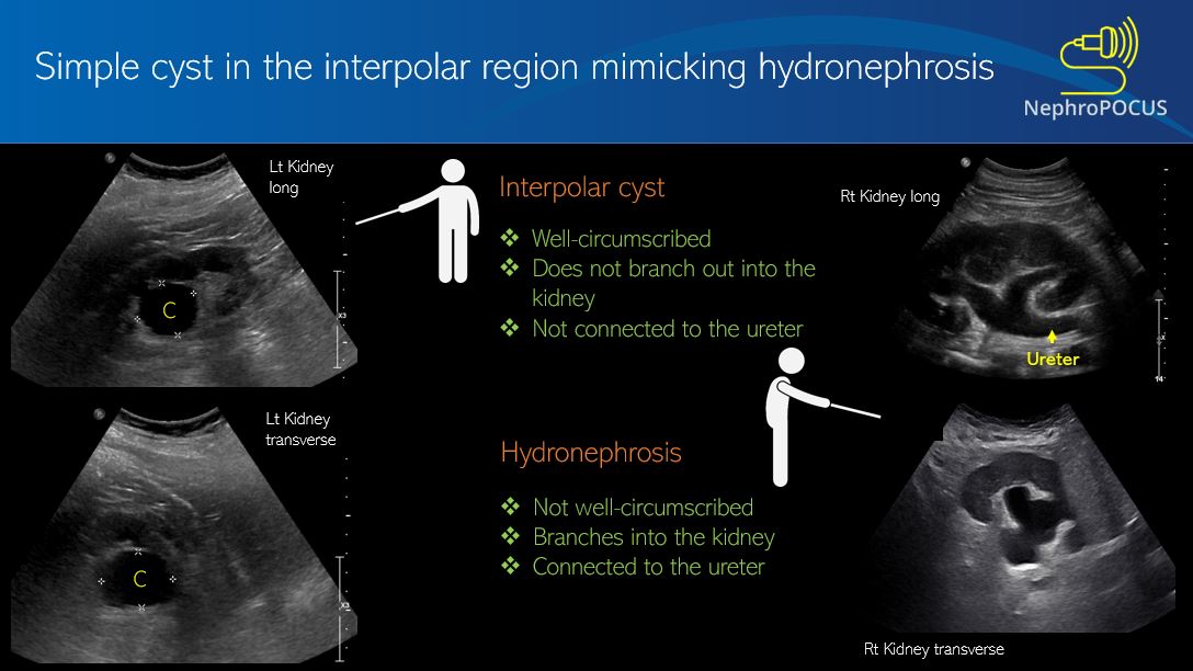 Parapelvic Cyst – NephroPOCUS