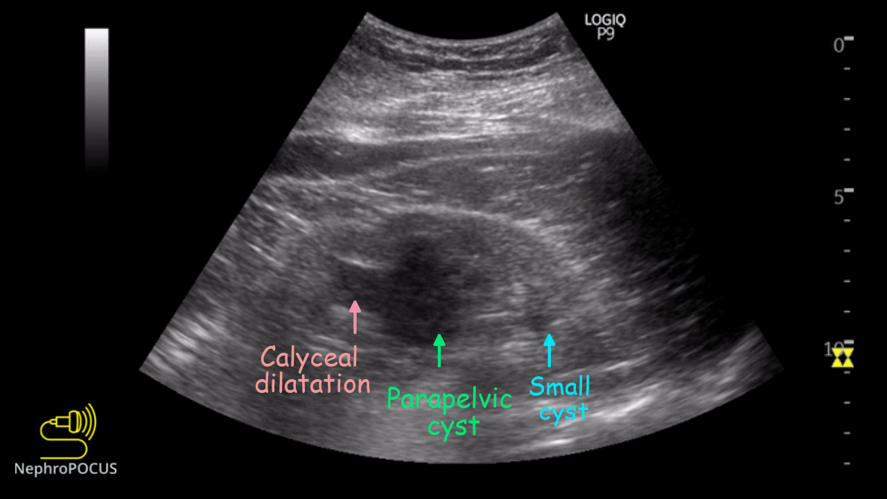 Parapelvic Cyst – NephroPOCUS