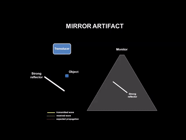 Mirror image artefact – NephroPOCUS