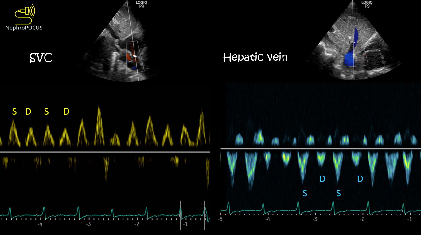 The subcostal bicaval view – NephroPOCUS