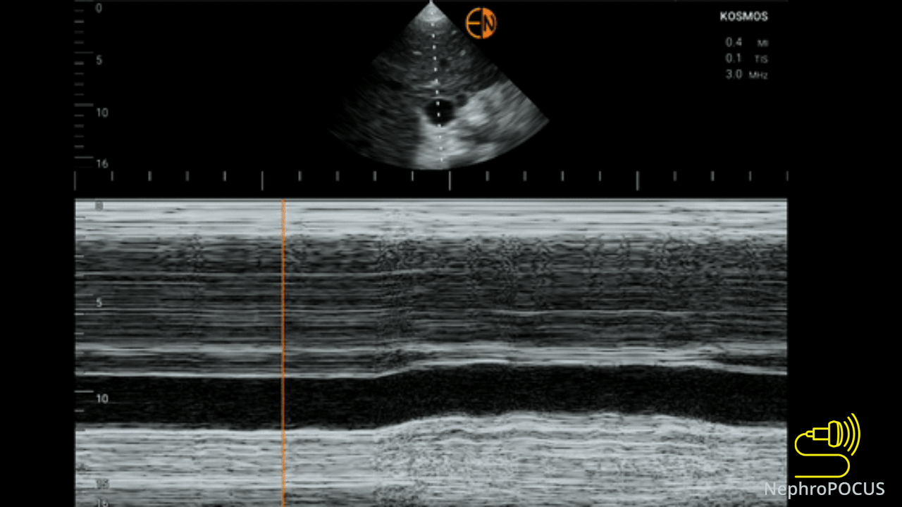 IVC POCUS: one view is no view – NephroPOCUS