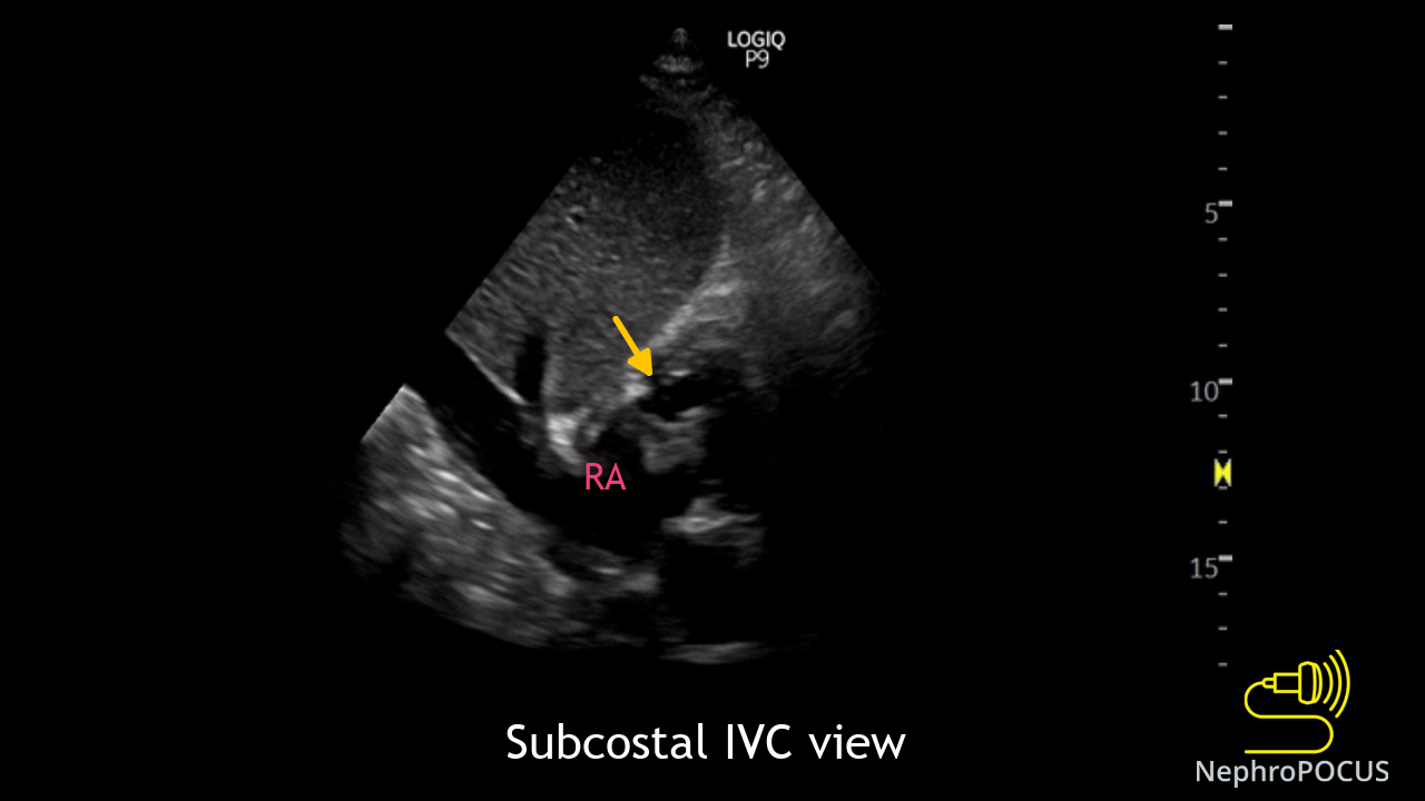 Subxiphoid IVC view: beyond estimation of right atrial pressure ...