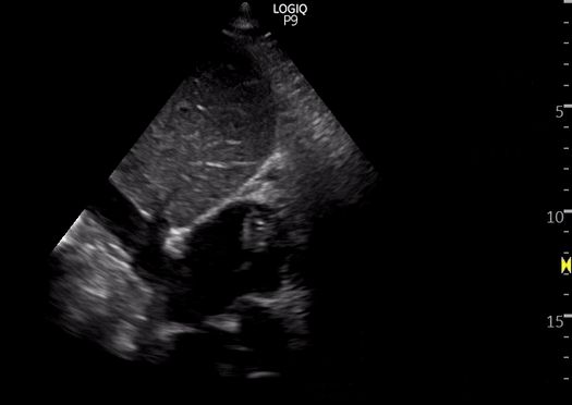 Subxiphoid IVC view: beyond estimation of right atrial pressure ...