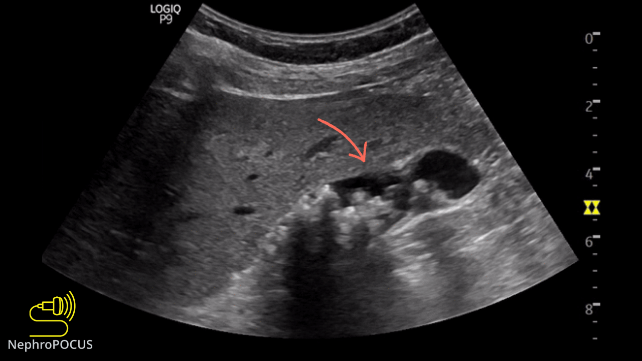 Incidental findings in the gall bladder lumen – NephroPOCUS