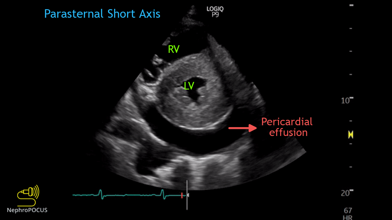 Figure-2-labeled – NephroPOCUS