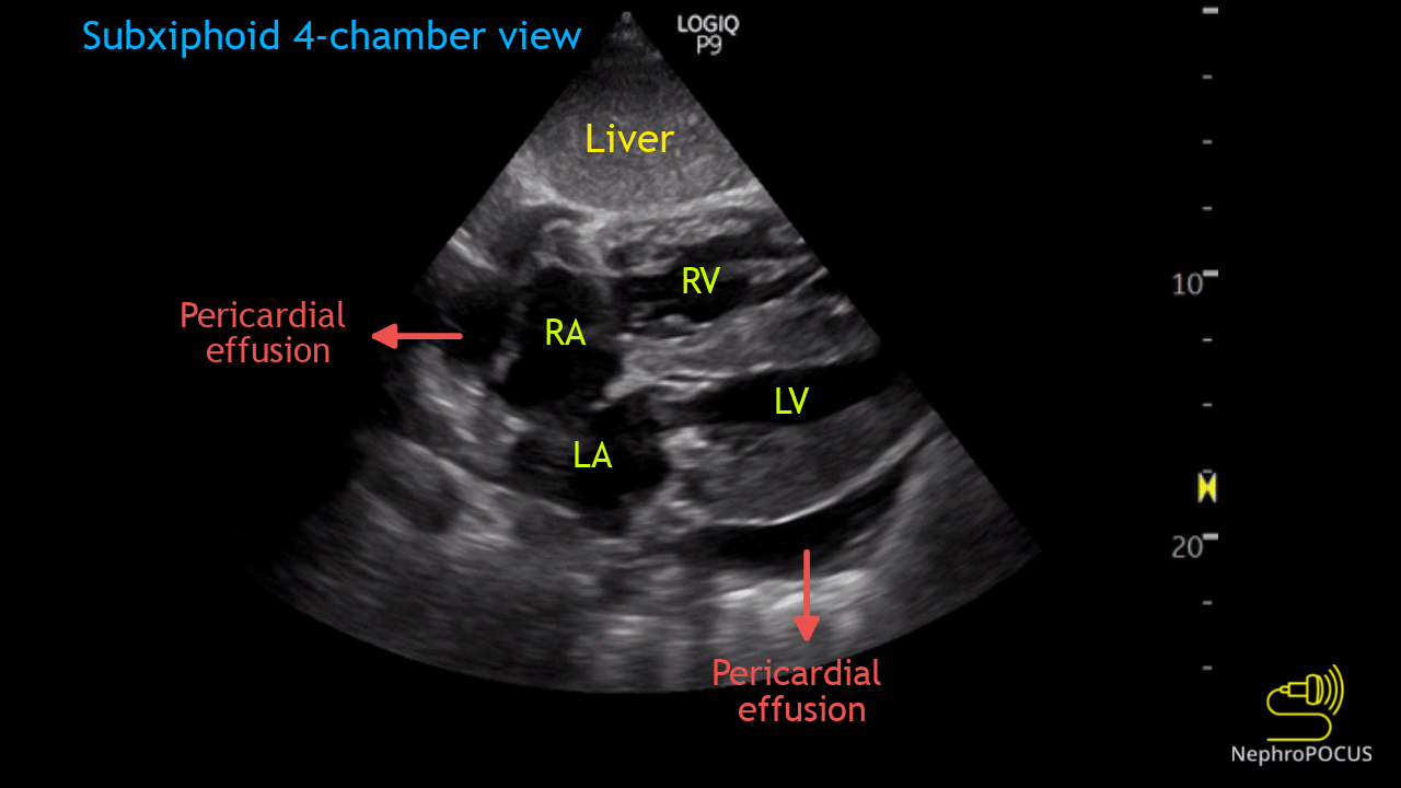 Figure-4-labeled – NephroPOCUS