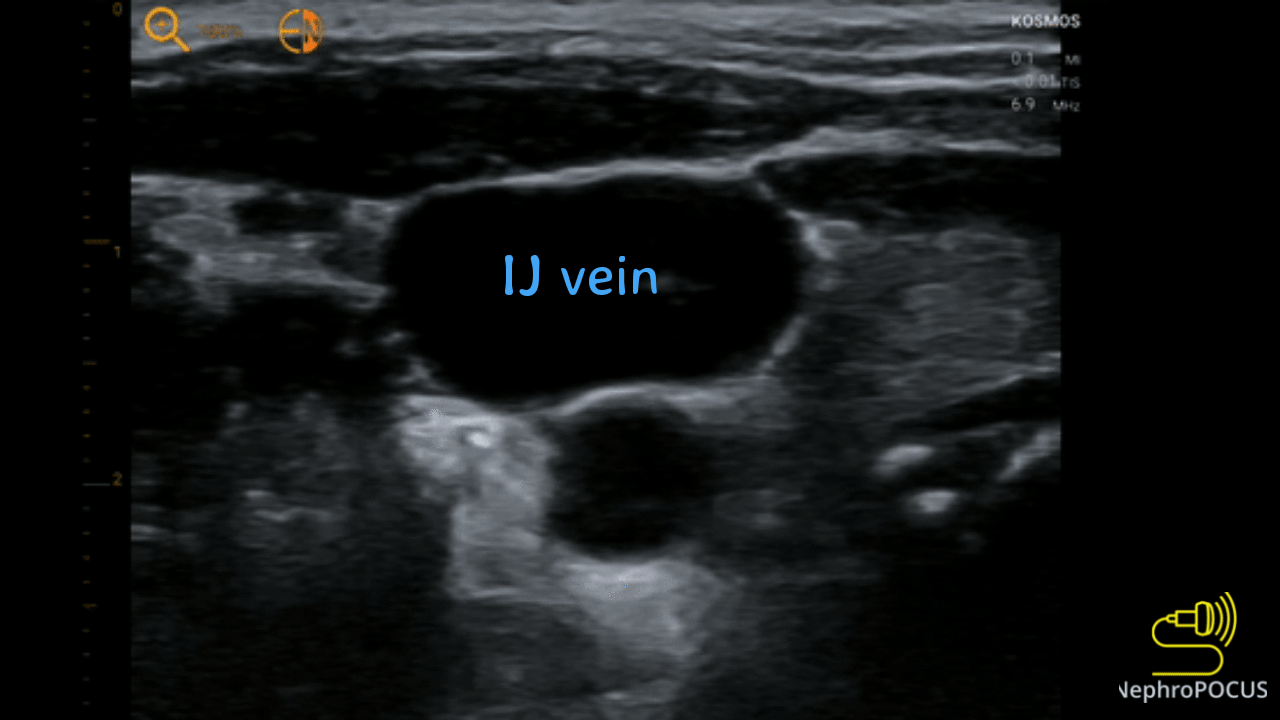 Internal jugular vein response to Valsalva maneuver – NephroPOCUS