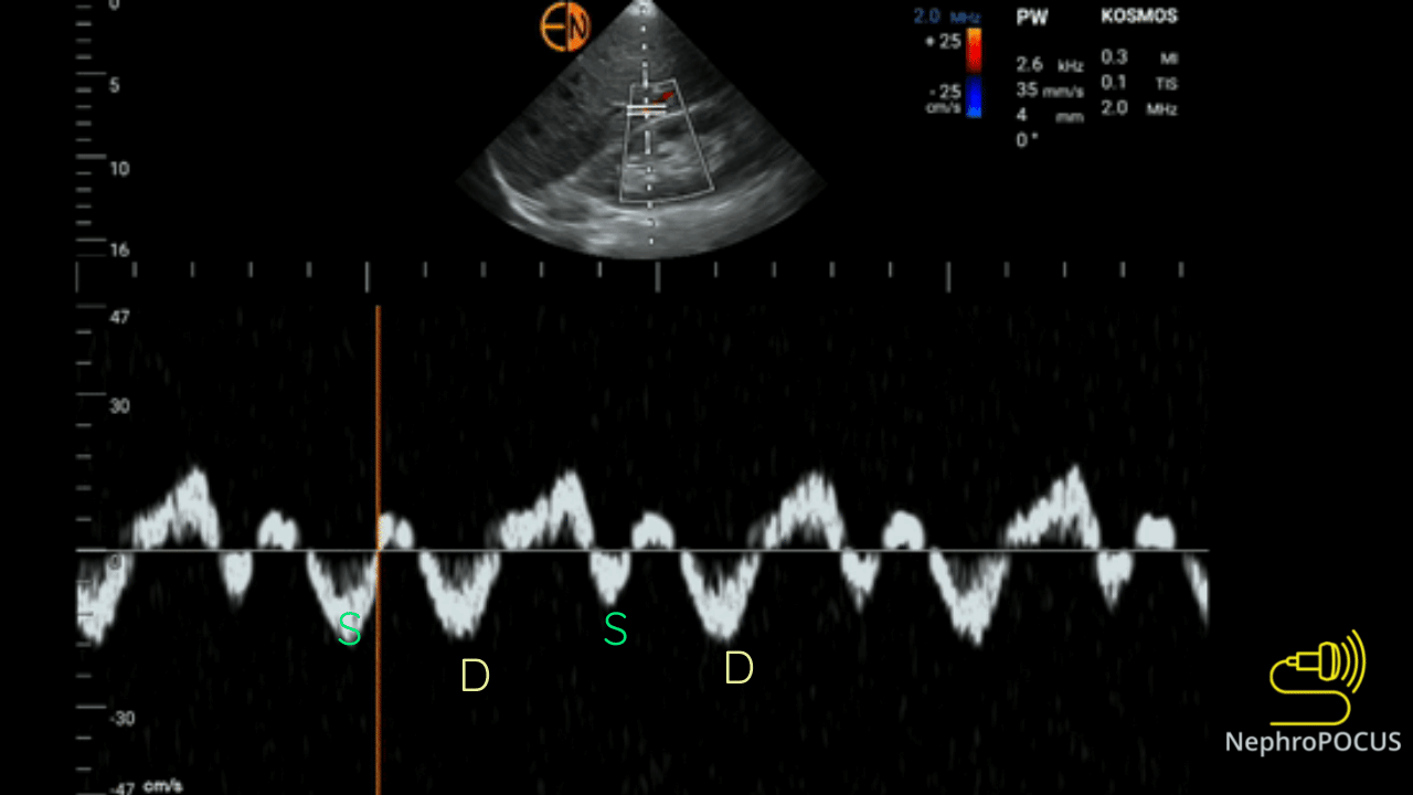Multi-parametric POCUS approach in heart failure – NephroPOCUS