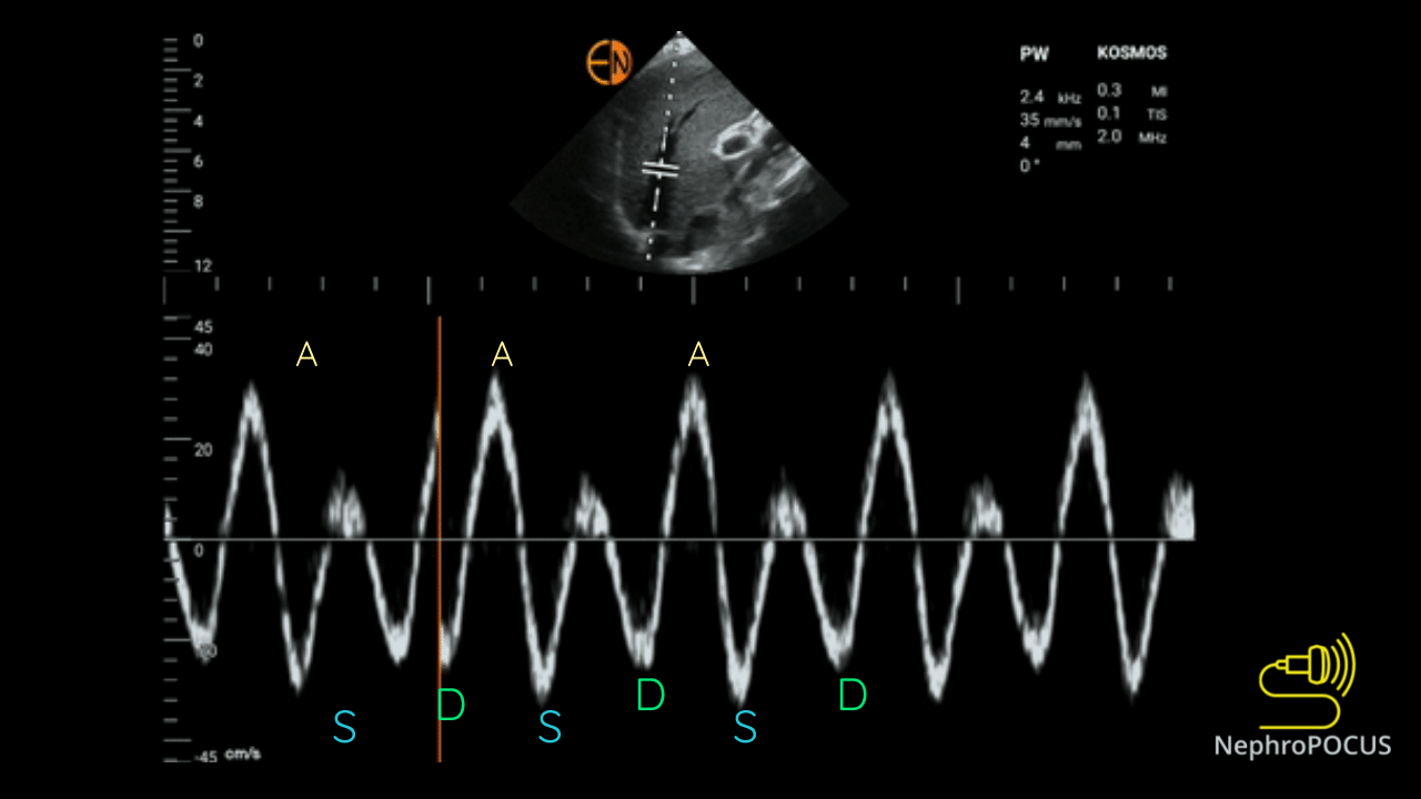Multi-parametric POCUS approach in heart failure – NephroPOCUS