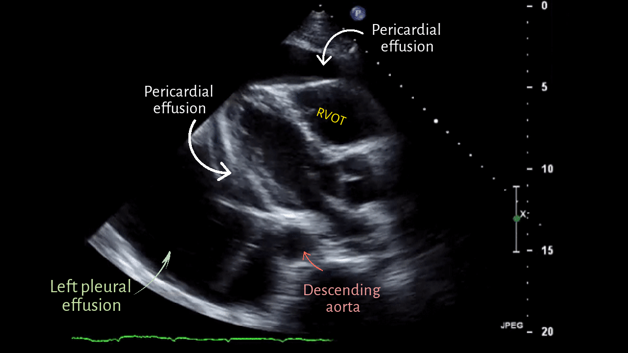 Pericardial versus pleural effusion on PLAX view – NephroPOCUS