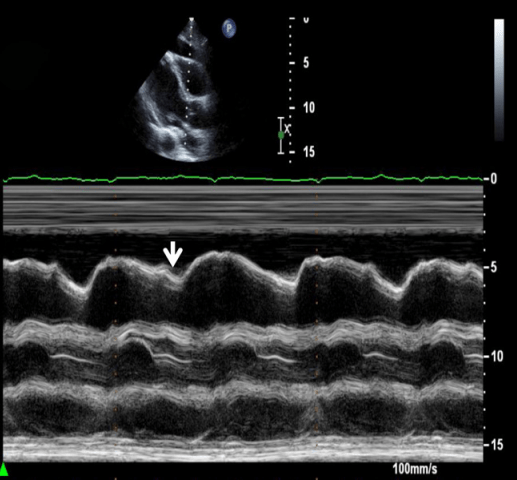 Pericardial versus pleural effusion on PLAX view – NephroPOCUS