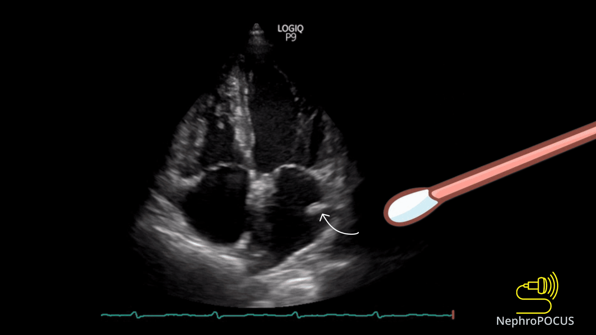 Left atrial ridge – NephroPOCUS