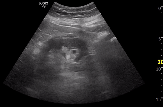A case of hydronephrosis – NephroPOCUS