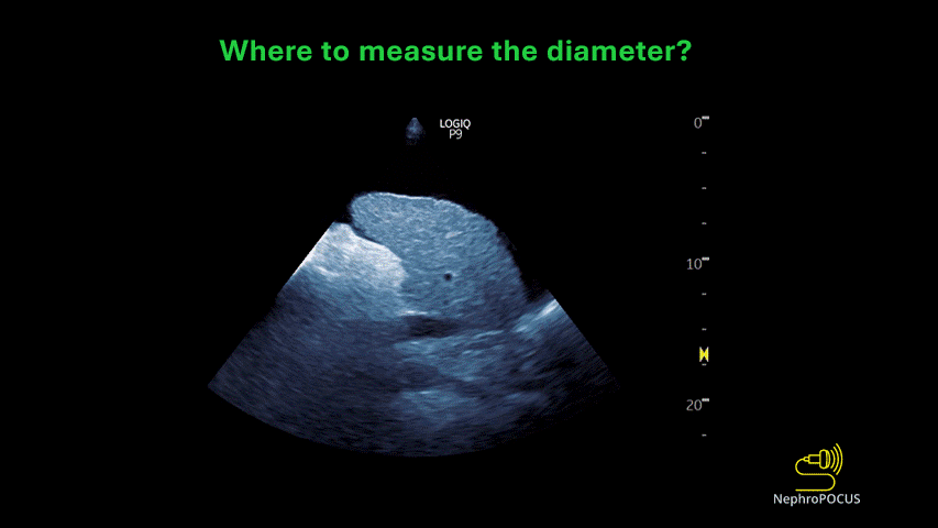 Hemodynamic POCUS in cirrhosis: think beyond the IVC – NephroPOCUS