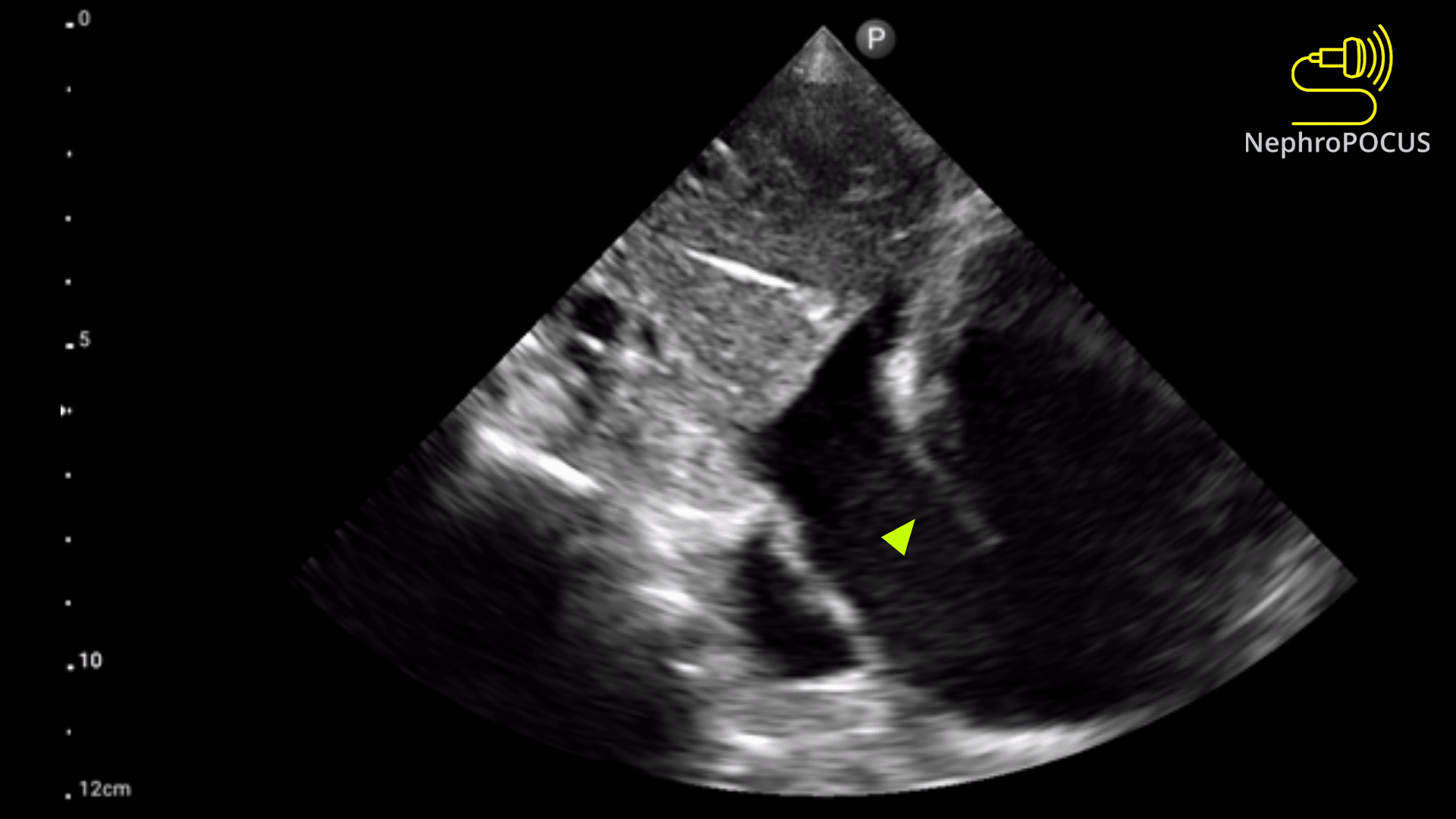 Prominent Eustachian valve and Chiari network – NephroPOCUS