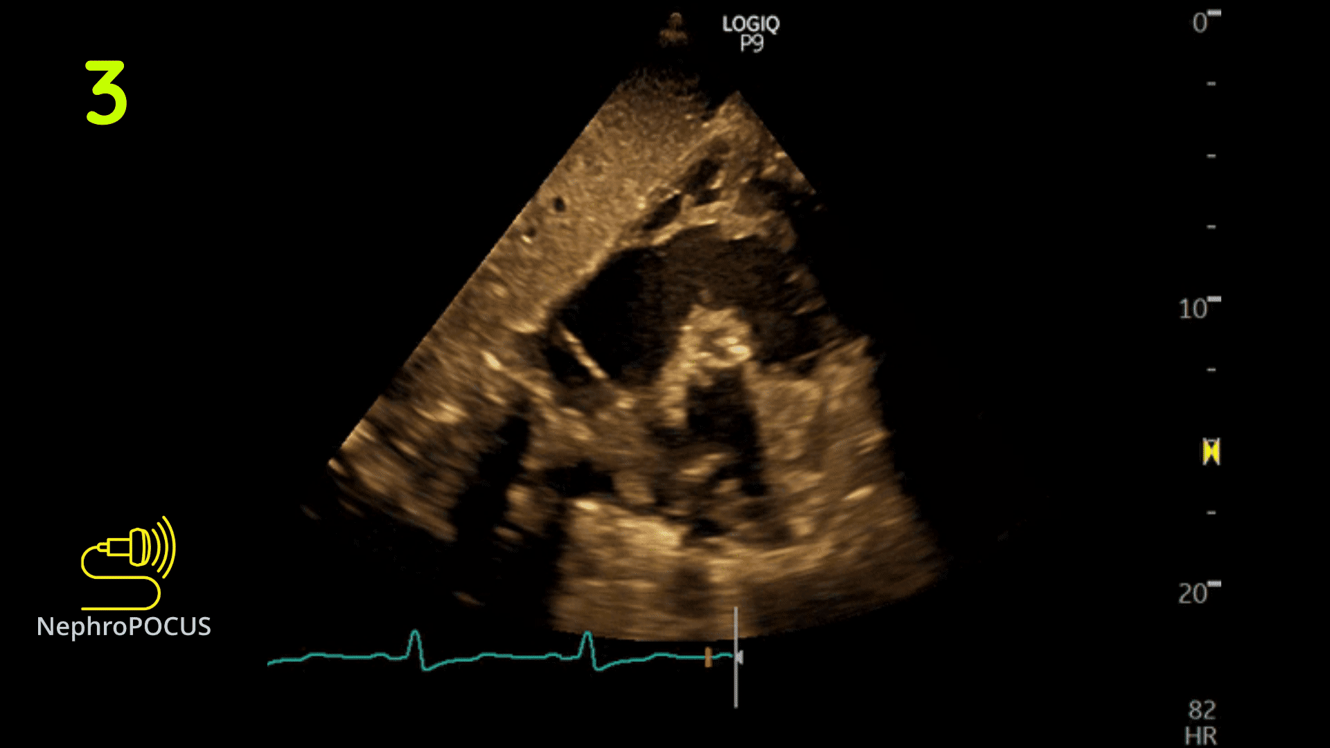 Dialysis catheter tip position on POCUS: may not be straightforward ...