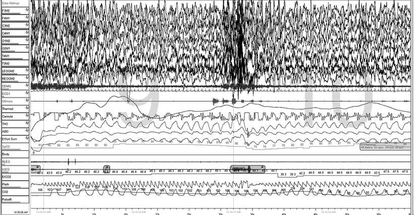 Interventions in the Pediatric Sleep Laboratory | Neupsy Key
