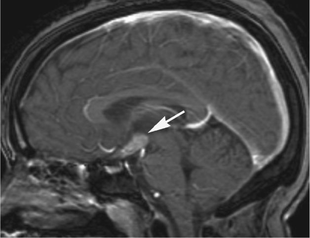 Encephalopathy and coma | Neupsy Key