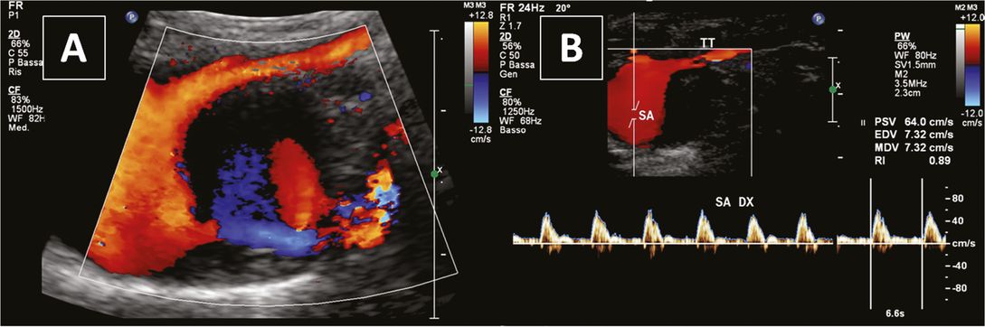 Cervical artery dissection | Neupsy Key